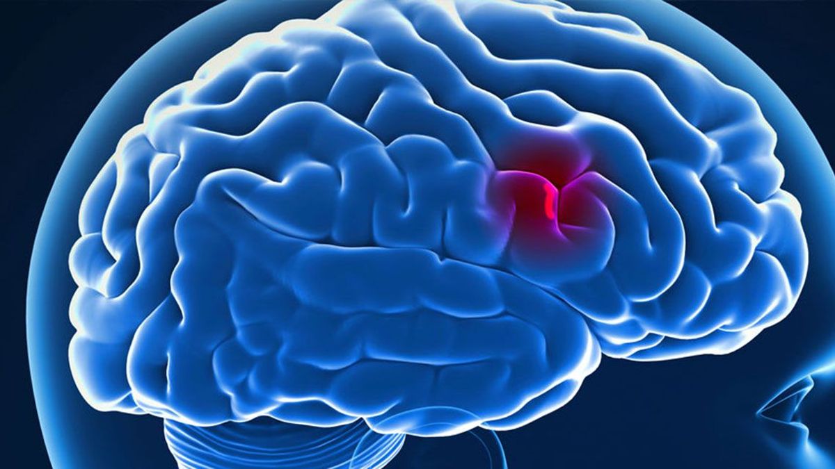 Hoy es el Día Mundial del ACV y se lo conmemora con distintas actividades