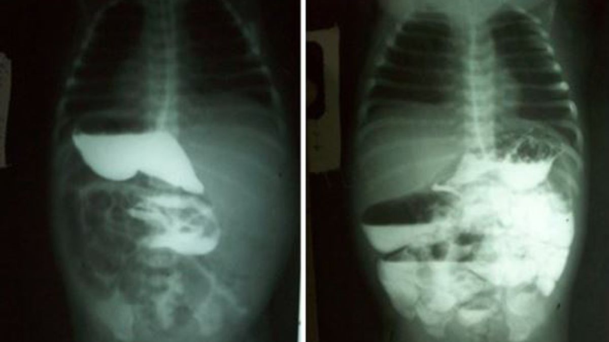 Qué es una brida intestinal y cómo es la operación que le realizaron a ...