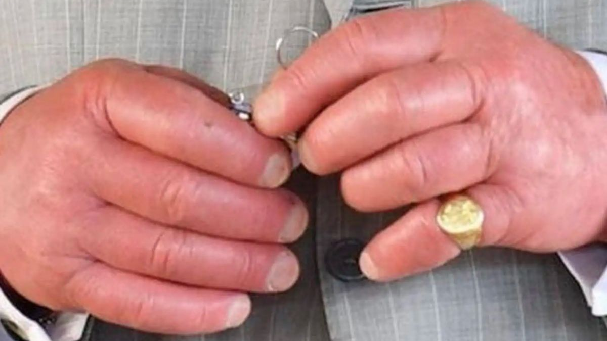 ¿Por qué el Rey Carlos III tiene dedos salchicha y qué significa?