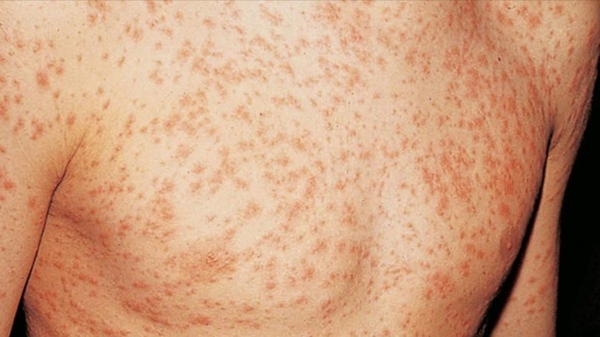 Alertan por la confirmación de un caso de rubéola