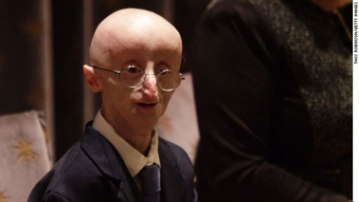 A los 17 años, murió el Benjamin Button de la vida real