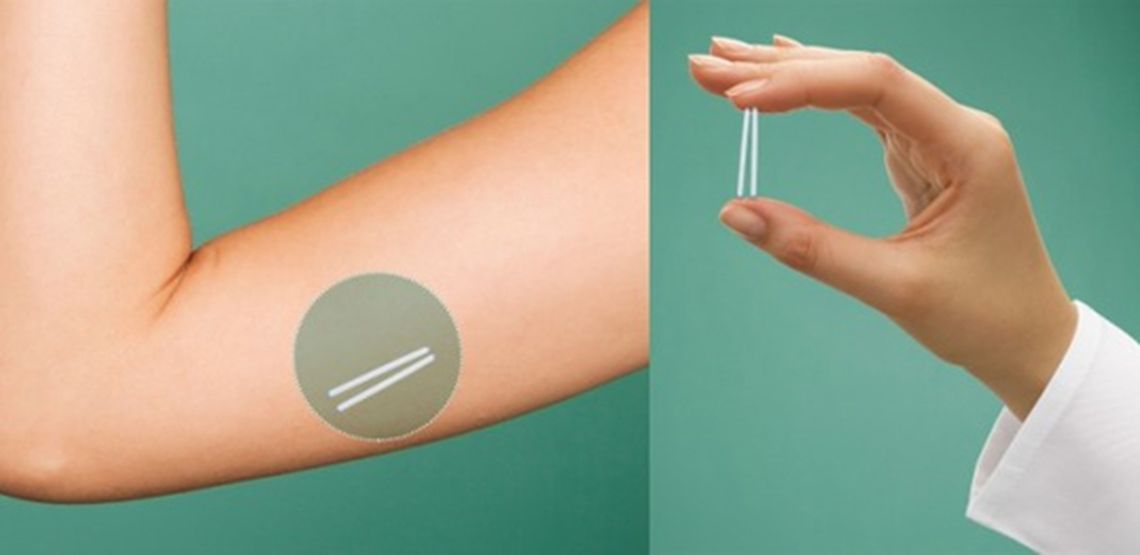 Día de la Anticoncepción: aumentó un 1.500% el implante subdérmico | La ...