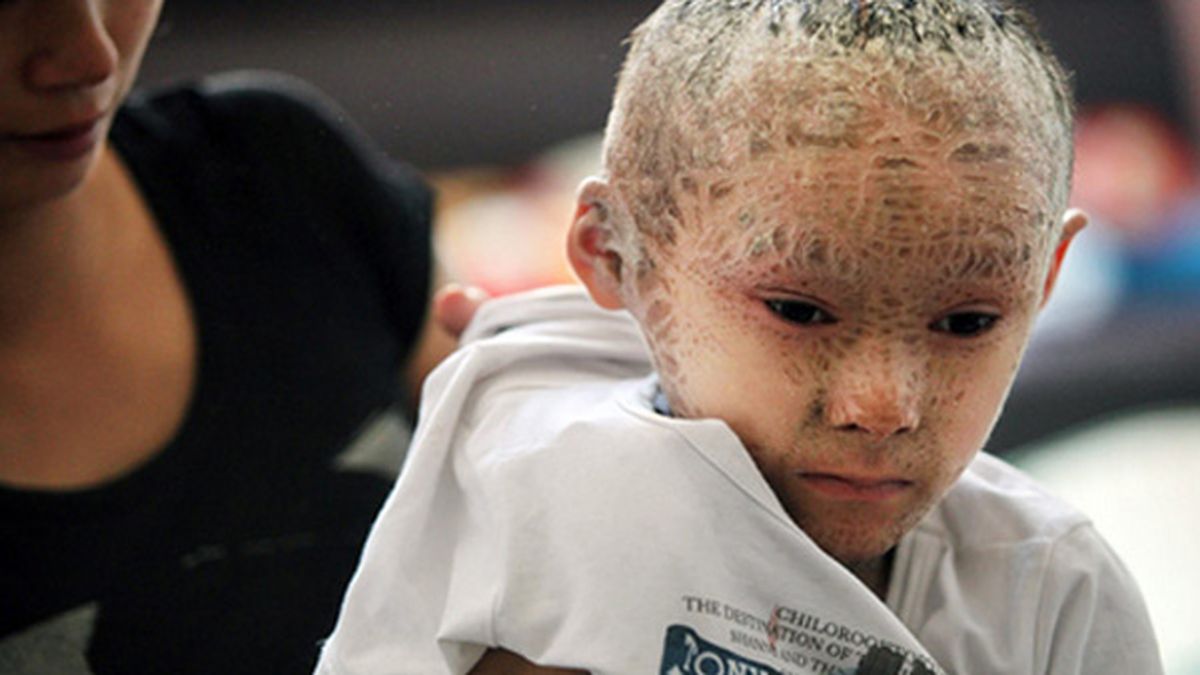 El niño pez, cubierto de escamas de pies a cabeza