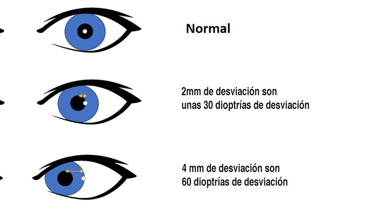 El estrabismo de Leonardo