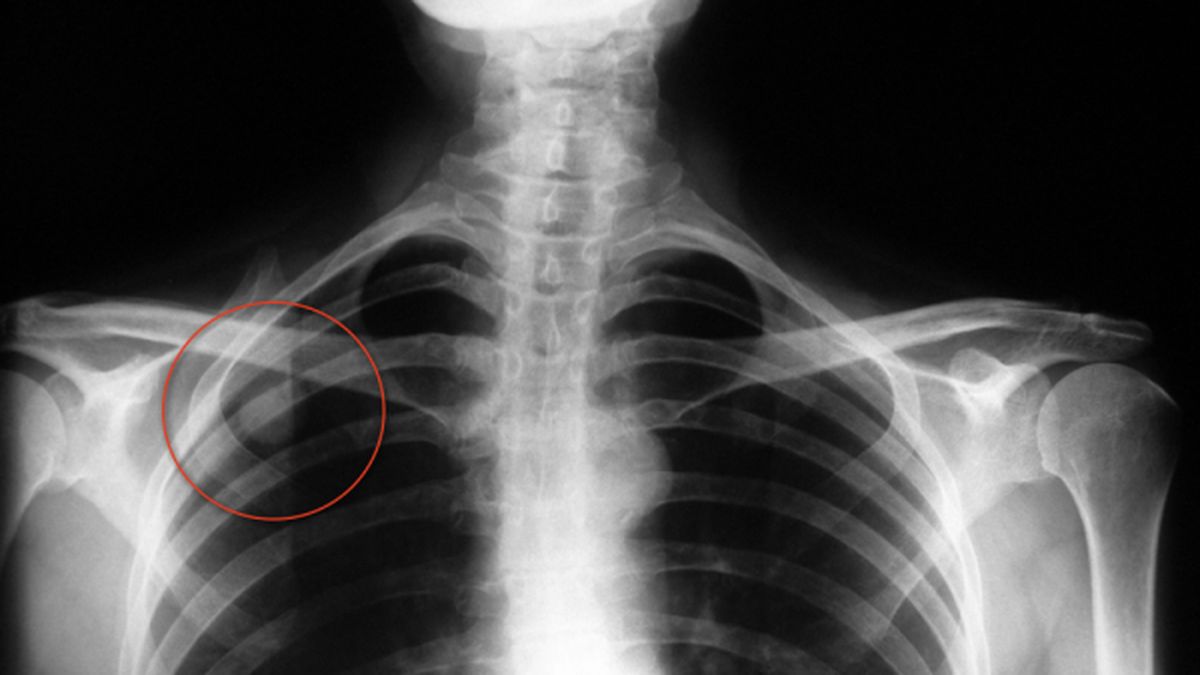 Qué es un nódulo pulmonar, lo que le extrajeron a Carolina Stanley